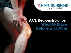 ACL Reconstruction: What to Know Before and After - Multispeciality ...