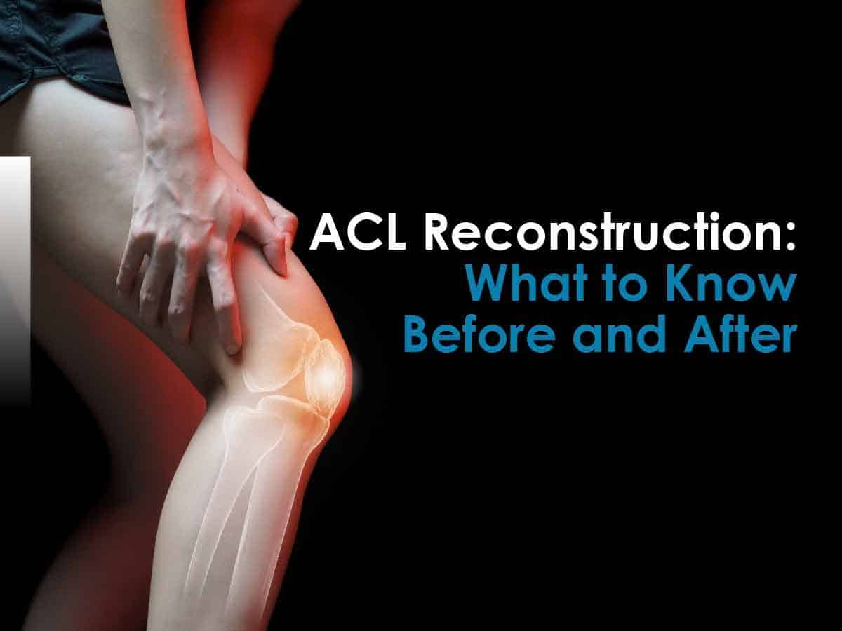 ACL Reconstruction: What to Know Before and After - Multispeciality ...