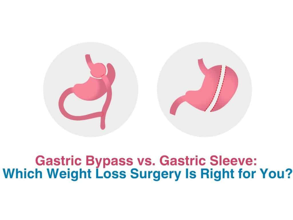 Gastric Bypass vs. Gastric Sleeve: Which Weight Loss Surgery Is Right ...
