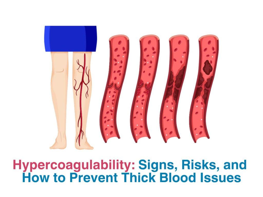Hypercoagulability: Signs, Risks, and How to Prevent Thick Blood Issues ...