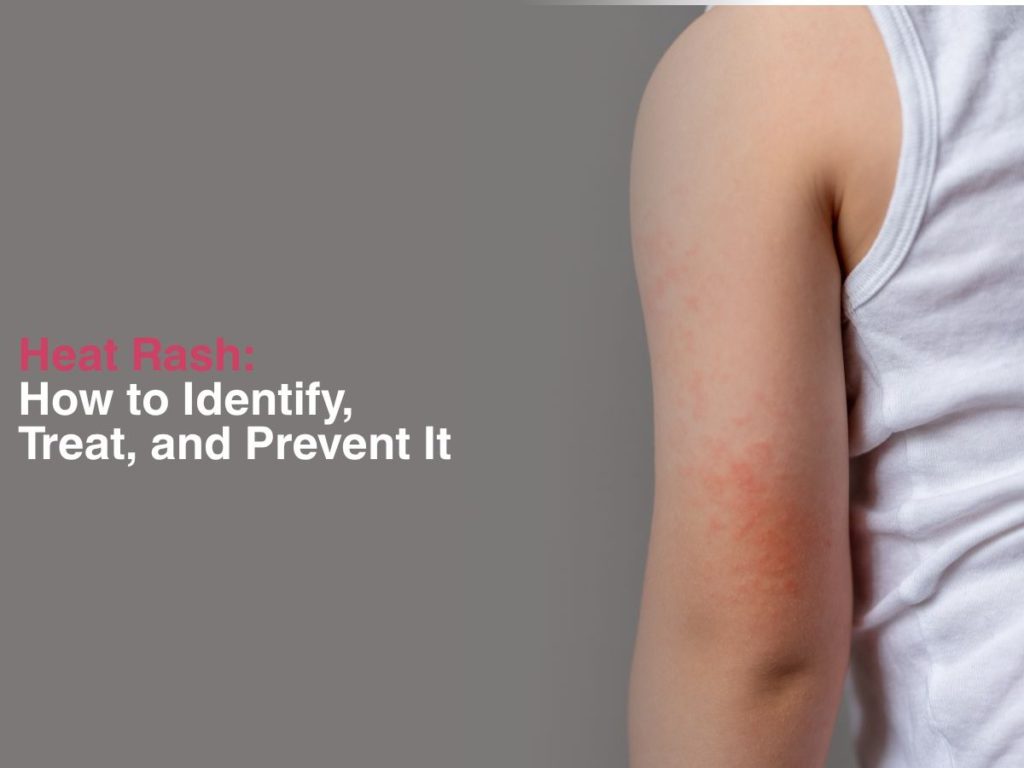 Heat Rash: How to Identify, Treat, and Prevent It