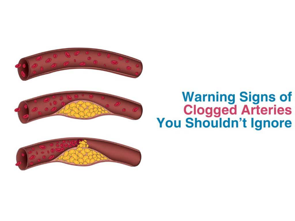Warning Signs of Clogged Arteries You Shouldn’t Ignore