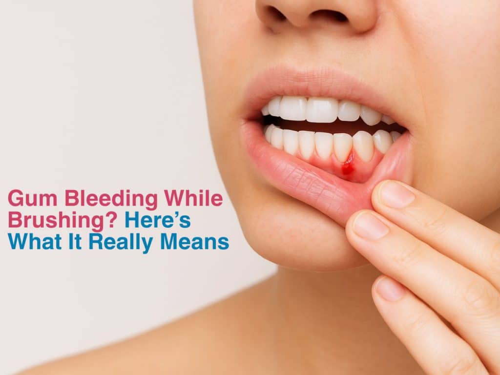 Gum Bleeding While Brushing? Here’s What It Really Means ...