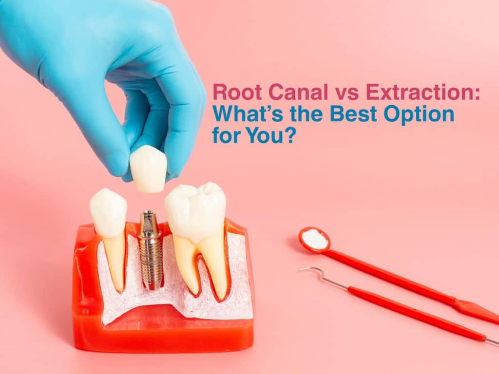 Root Canal vs Extraction: What’s the Best Option for You?
