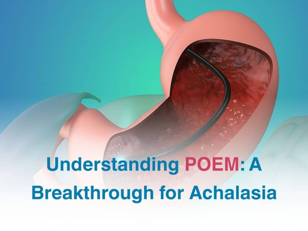 Understanding POEM: A Breakthrough for Achalasia