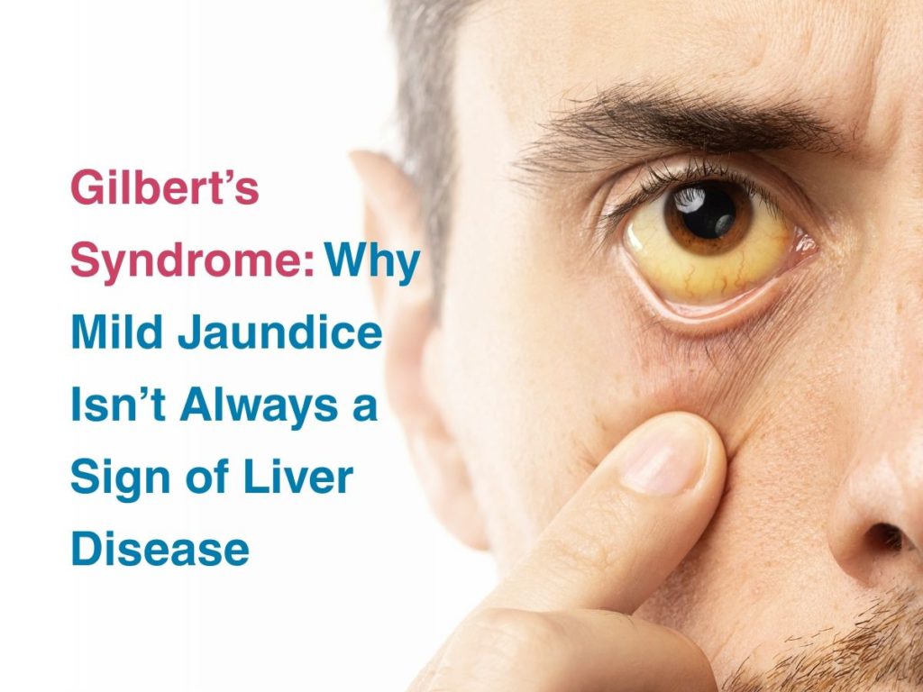 Gilbert’s Syndrome: Why Mild Jaundice Isn’t Always a Sign of Liver Disease