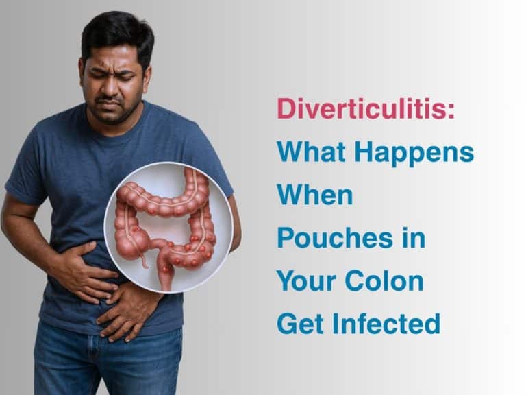 Diverticulitis: What Happens When Pouches in Your Colon Get Infected