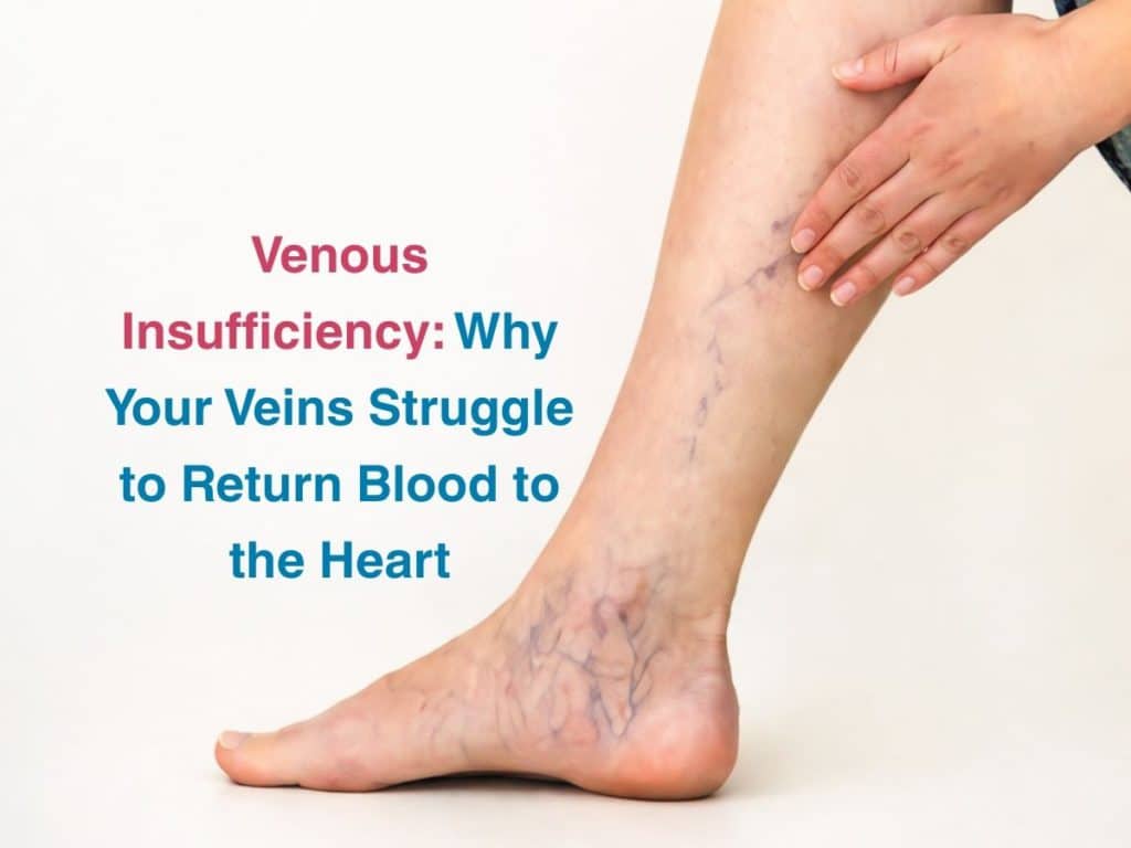 Venous Insufficiency: Why Your Veins Struggle to Return Blood to the Heart